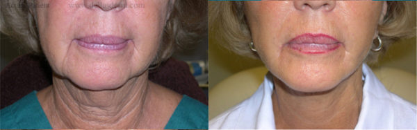 Mini Face Lift Treatment in Dallas | View Minilift Options