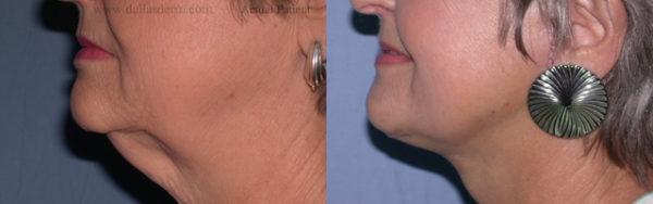 Mini Face Lift Treatment in Dallas | View Minilift Options