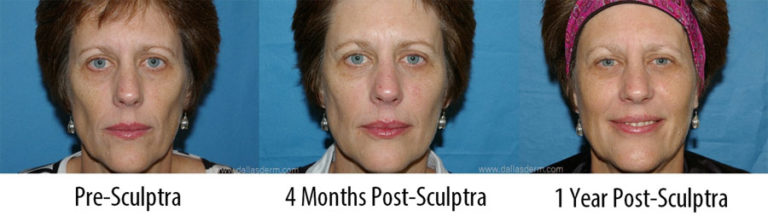 Sculptra provided service by Drs. Maris and Euwer